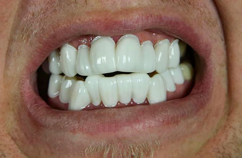 Knock Off Page - Dental Veneers | Brighter Image Lab