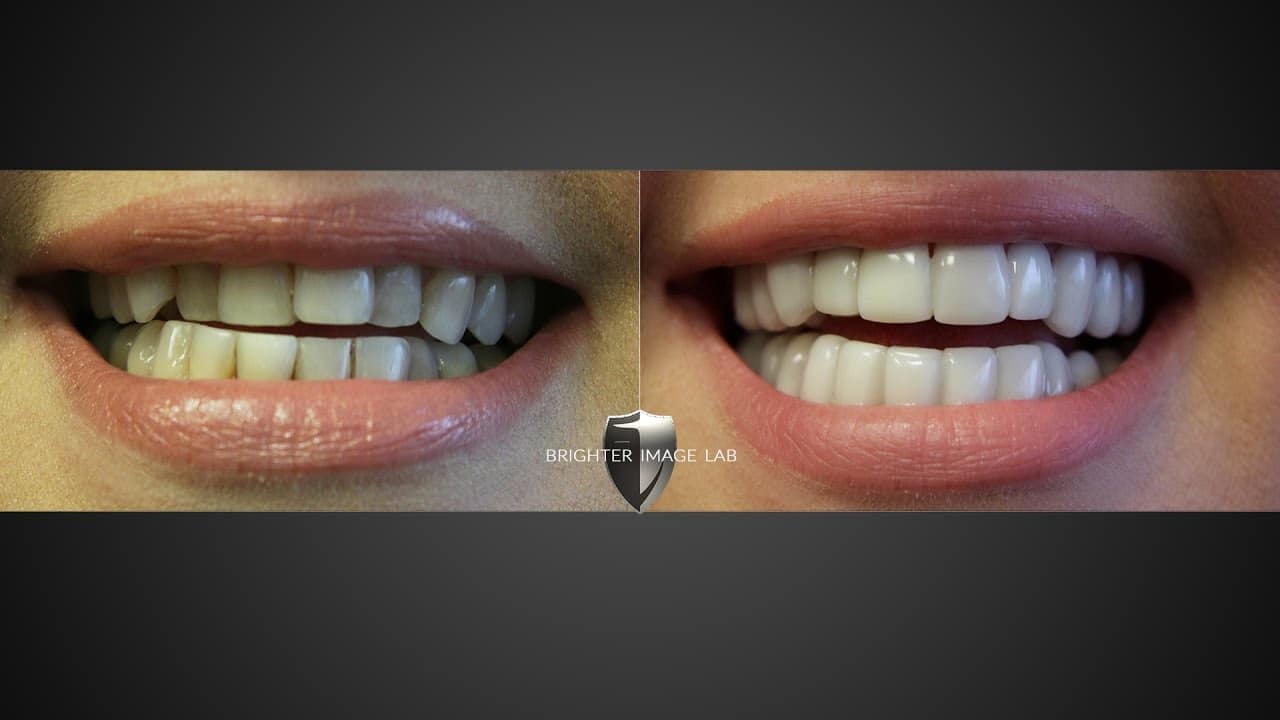 Instasmile vs Brighter Image Lab – 3 Unexpected Differences