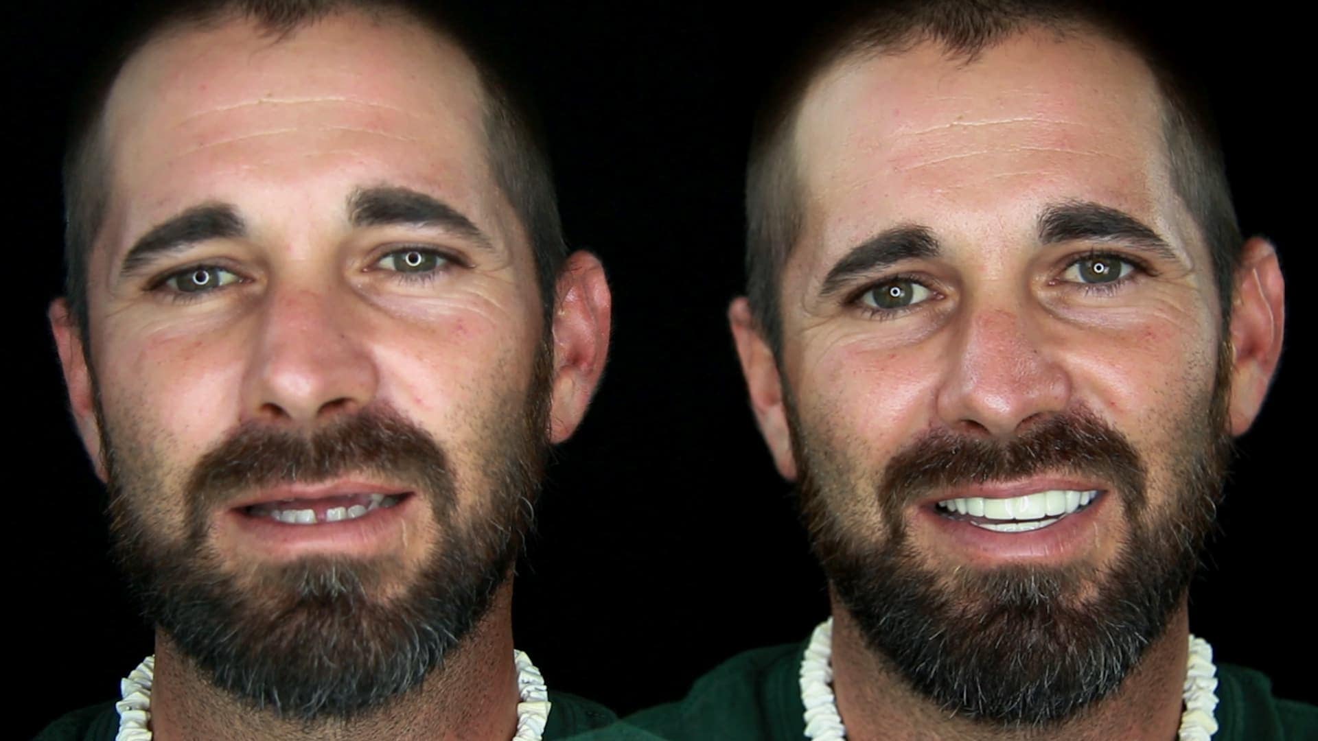 Terrifying Accident Smile Makeover 12 Minute Story