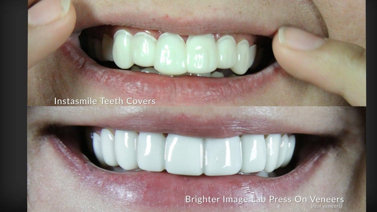 Learn the truth about Instasmile | Why $350 is not worth it