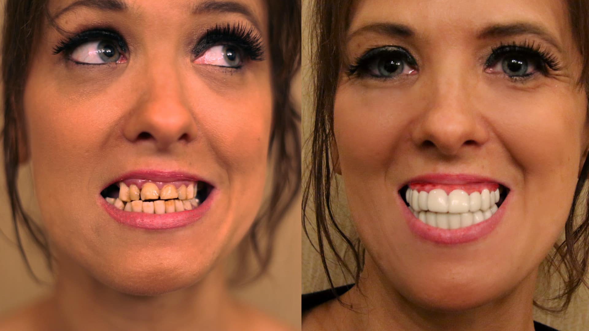 Remarkable Removable Porcelain Veneers 12 Minute Smile Fix