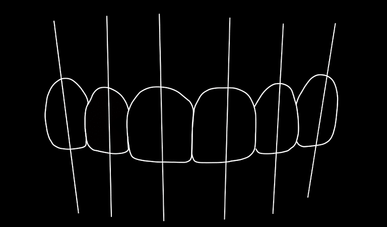 Brighter Image Lab Top 500 Veneers In Action - PressOn Veneers ...
