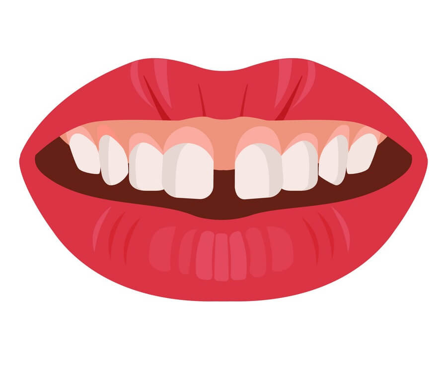 Gap Teeth Com Arreglar Les Teves Sense Pagar Milers Presson Veneers Brighter Image Lab Lloc