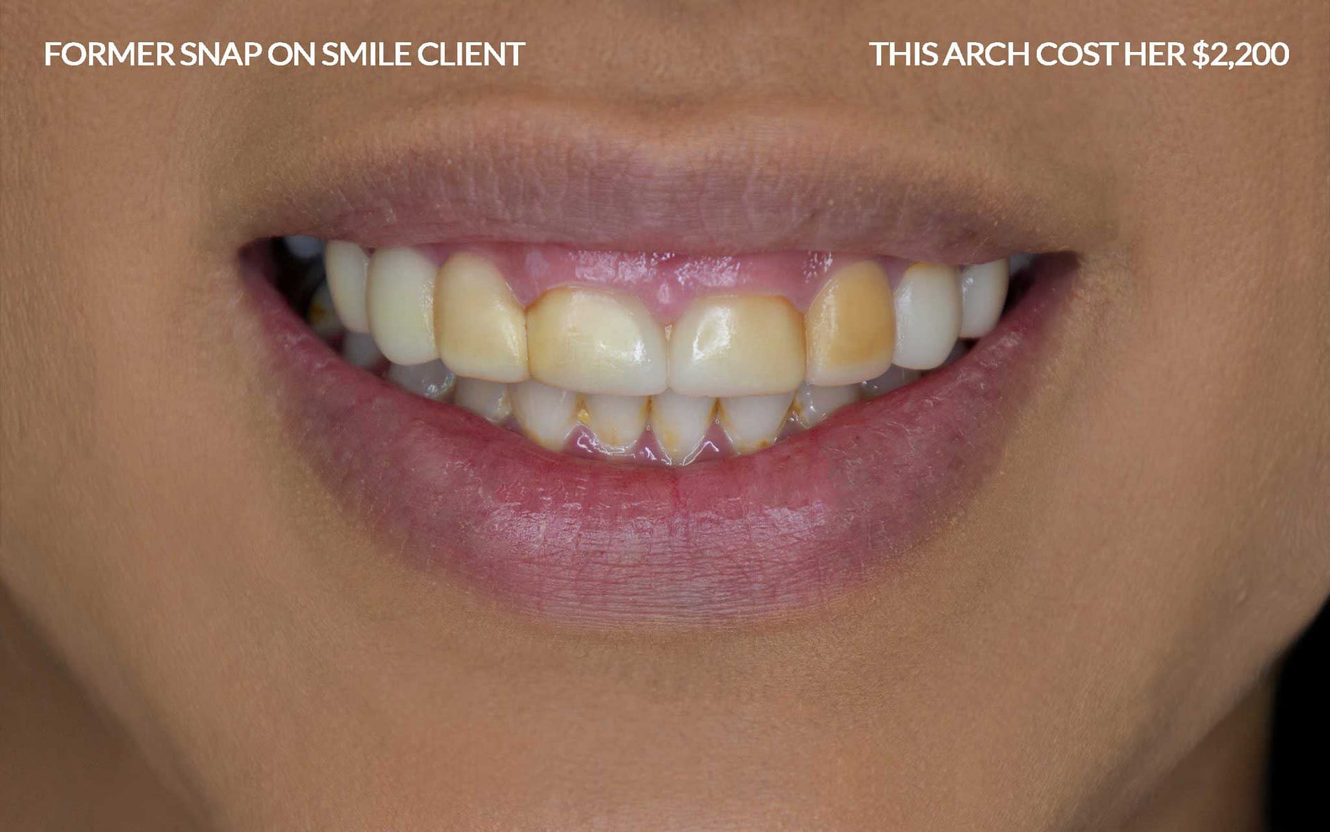 Snap On Veneers | Which Are The Best? #1 Affordable Veneers