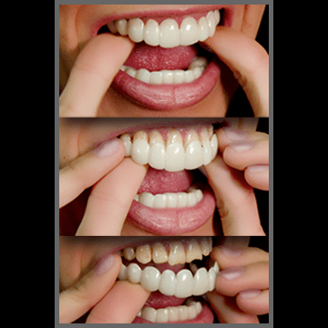 Snap On Veneers | Which Are The Best? #1 Affordable Veneers